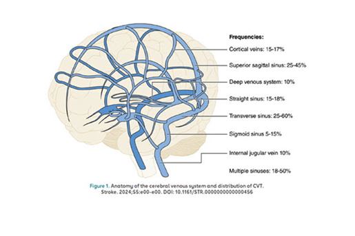Diagnosis And Management Of Cerebral Venous Thrombosis Professional