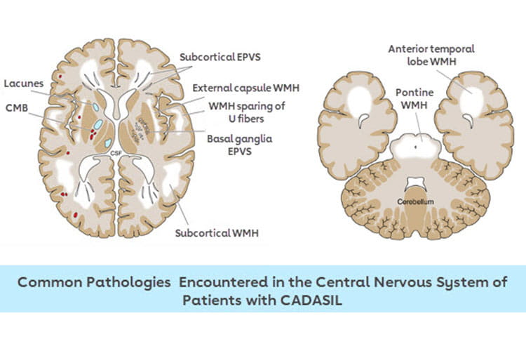 Management of Inherited CNS Small Vessel Diseases: The CADASIL Example ...