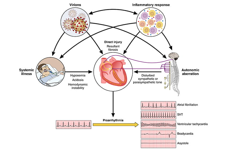 Cardiac Arrhythmias and Autonomic Dysfunction Associated With COVID-19 ...