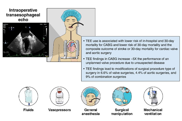 Considerations of Intraoperative Transesophageal Echocardiography ...