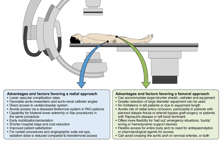 Radial Access Approach to Peripheral Vascular Interventions ...