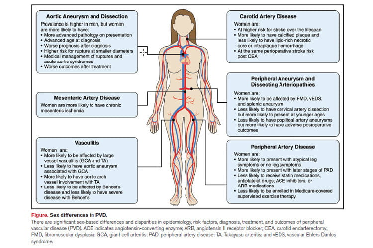 Sex Differences In Peripheral Vascular Disease Professional Heart