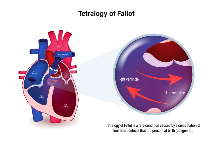 Long-Term Management of Right Ventricular Outflow Tract Dysfunction in ...
